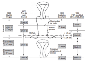 Prolapsus des organes pelviens - MedG