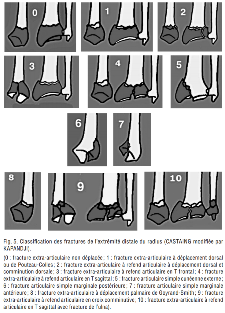 Fracture de l'extrémité inférieure du radius - MedG